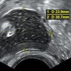 Ovariumcyste: een (goedaardig) gezwel in de eierstokken | Mens en ...