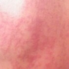 Urticaria: 'netelroos of galbulten' | Mens en Gezondheid: Aandoeningen